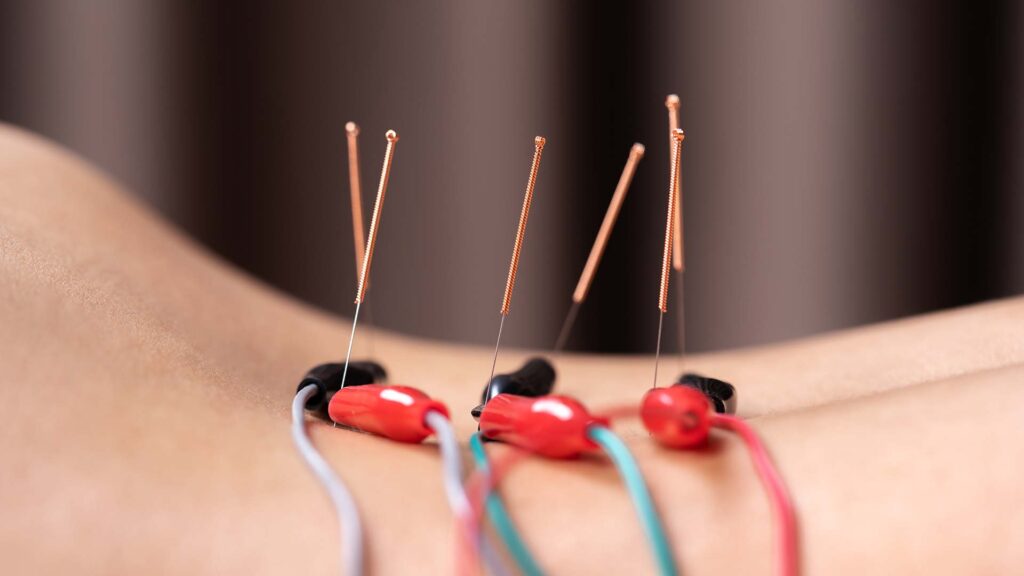 Electro Dry Needling - Osteopractor in Pennsylvania